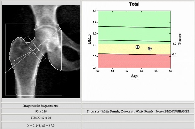 Bone Density Scan Results DXA Tests What You Must Know The Most 